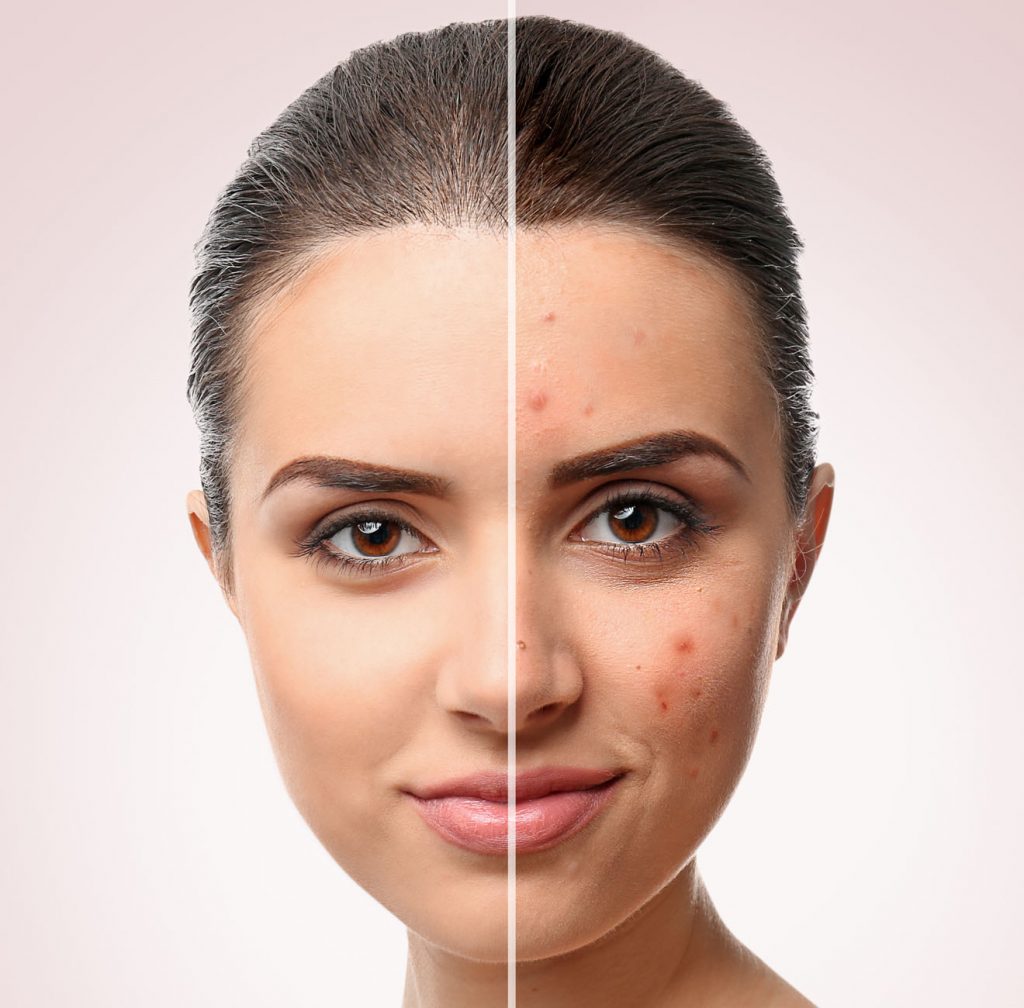 Acne Treatment Acne Scar Treatment London Dermacure