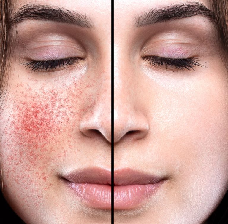 Dermacure London : The most exclusive Skin,Laser & Microblading Clinic