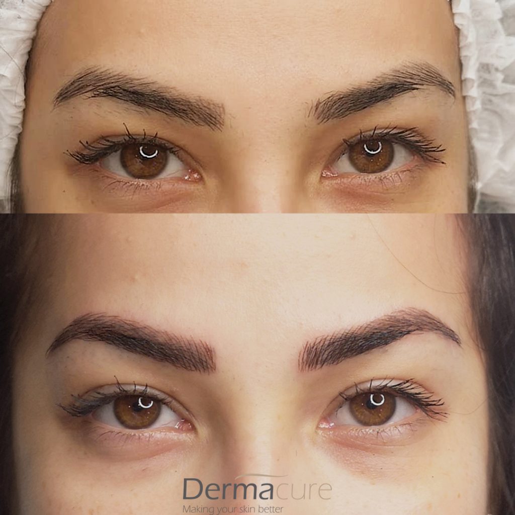 Microblading, Microblading Eyebrows, London - Dermacure