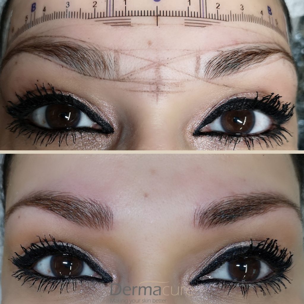 Microblading, Microblading Eyebrows, London - Dermacure