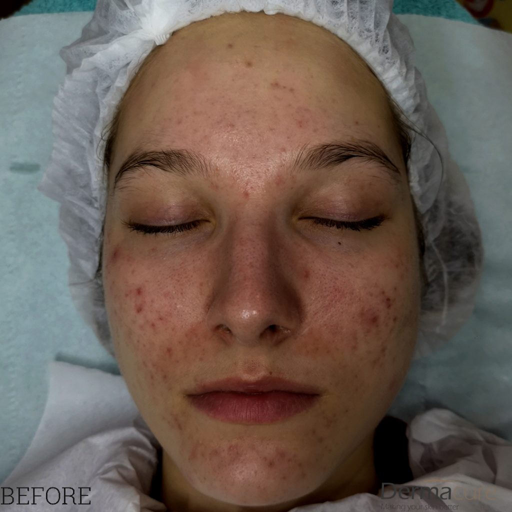 Laser Skin Resurfacing, Pixel Laser, London - Dermacure