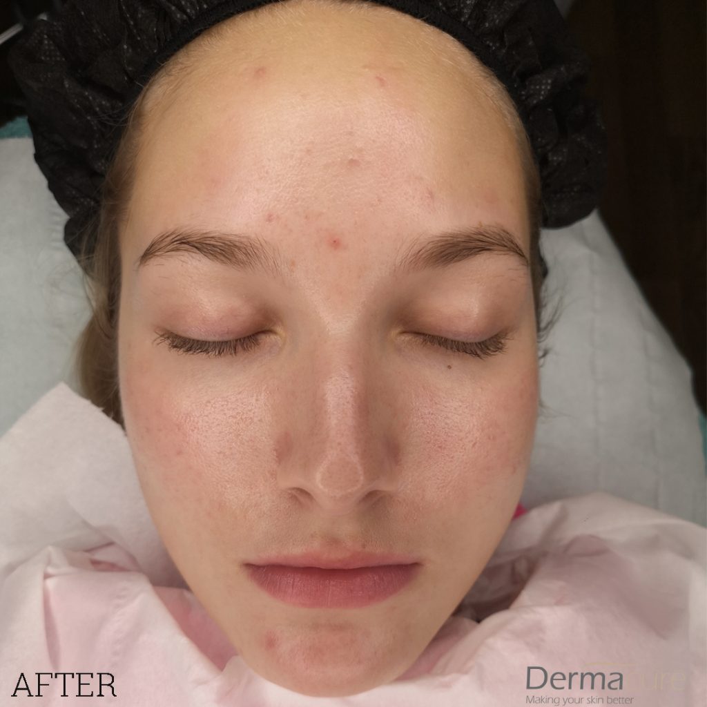Laser Skin Resurfacing, Pixel Laser, London - Dermacure