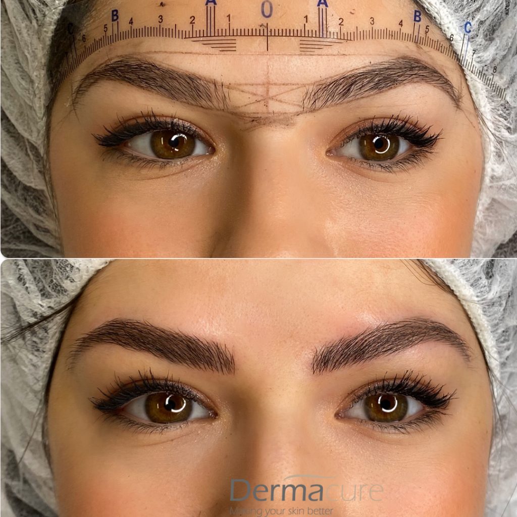 Microblading, Microblading Eyebrows, London - Dermacure