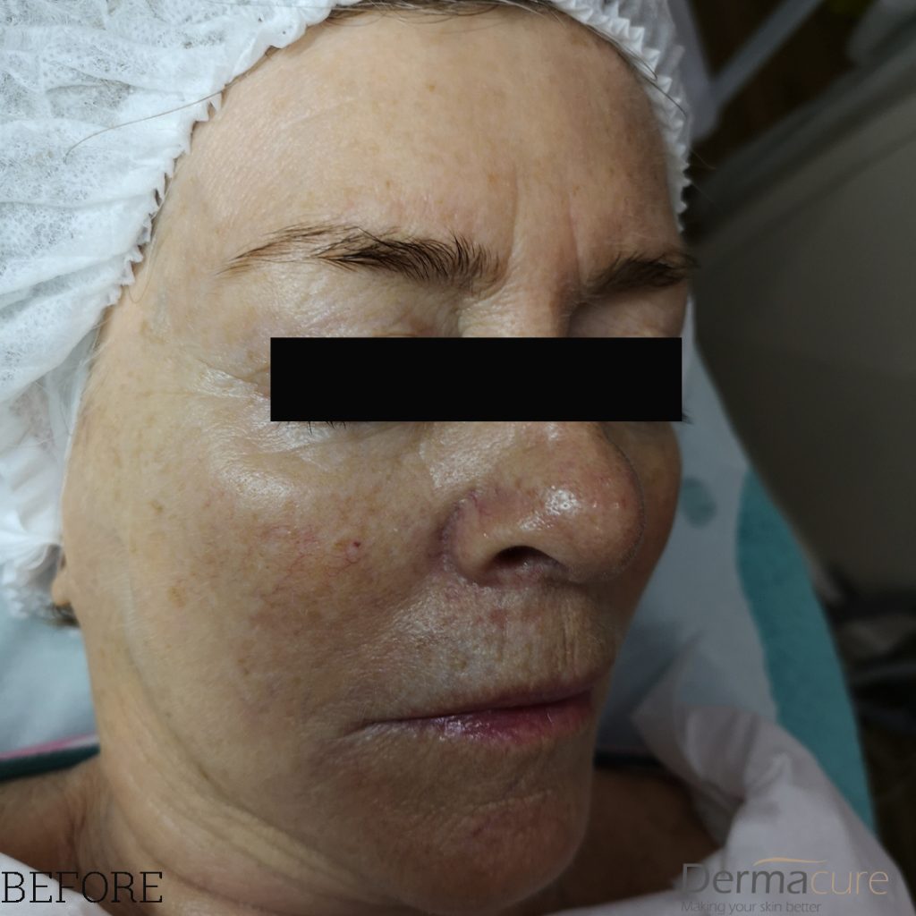 Hyperpigmentation, Pigment Treatment, London - Dermacure