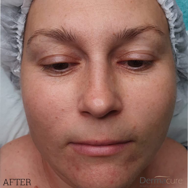 Hyperpigmentation, Pigment Treatment, London - Dermacure
