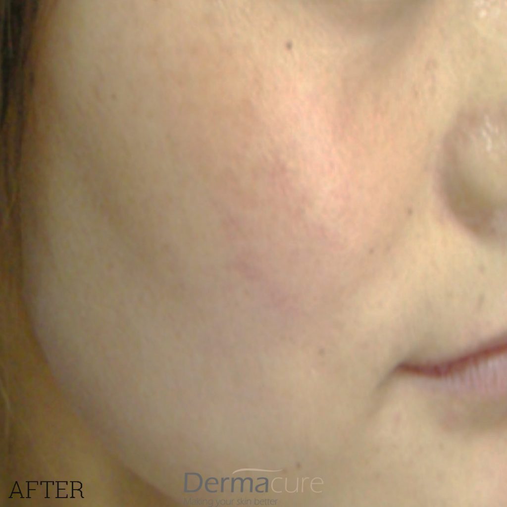 Vascular Laser Treatment, Harmony XL, London - Dermacure