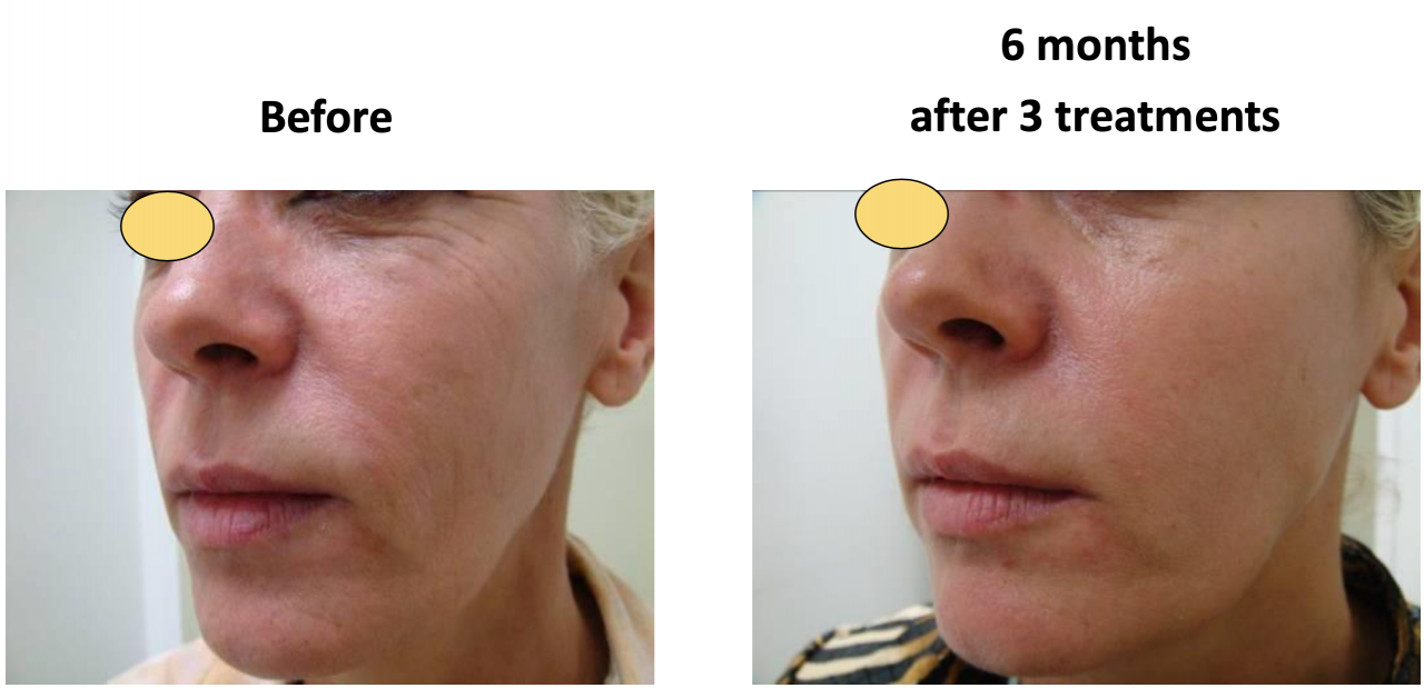 CleaLift, Laser Lift Treatment For Face, London - Dermacure