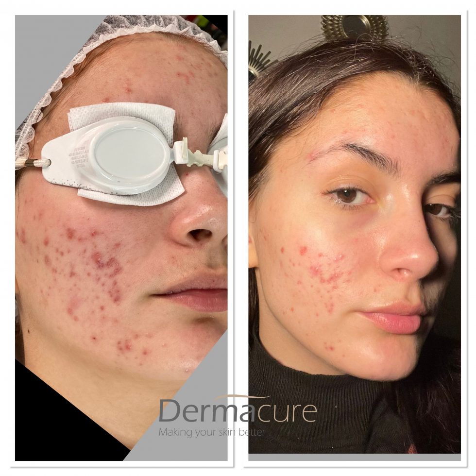 Acne Bespoke Treatment 3 Steps Dermacure Clinic