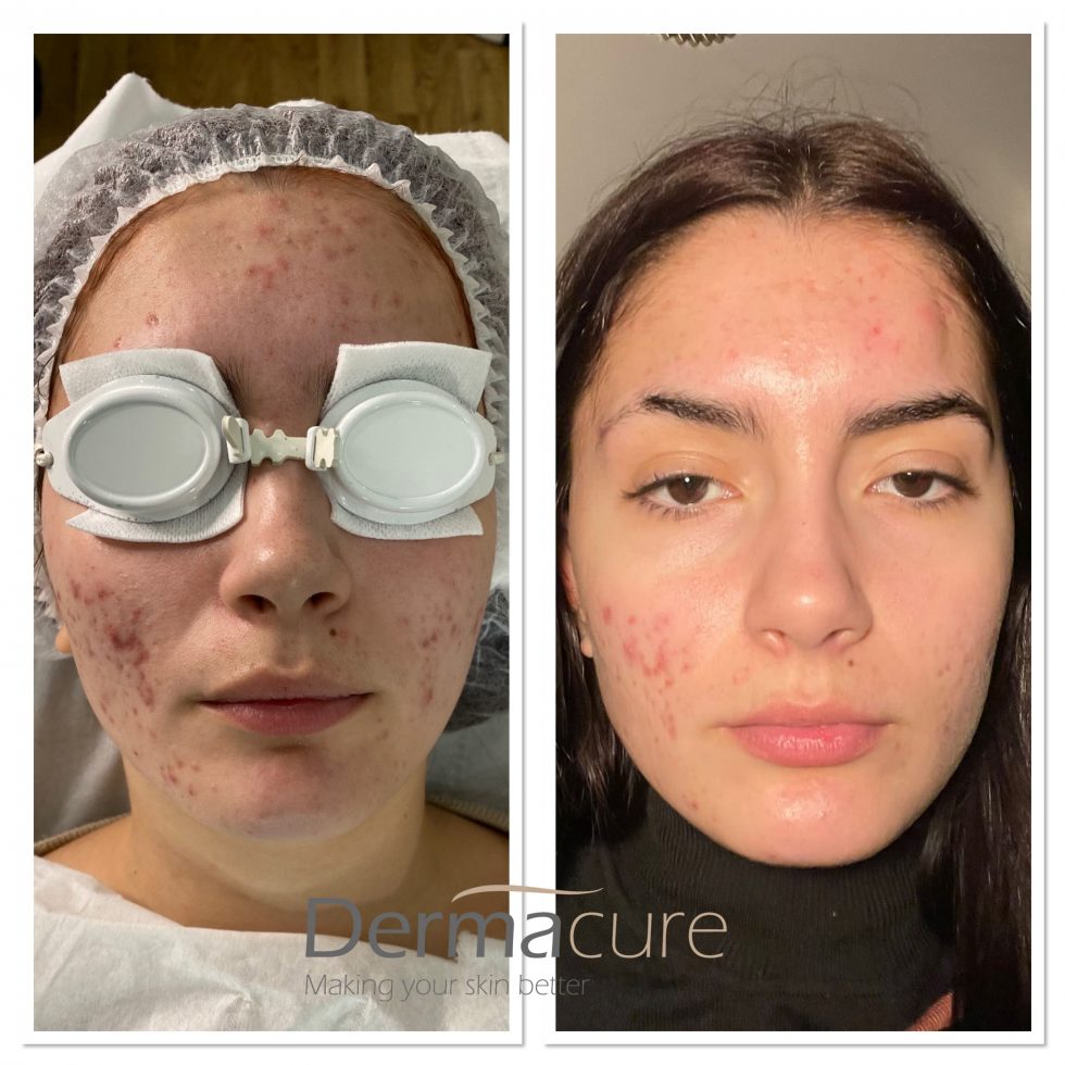 Acne Bespoke Treatment 3 Steps Dermacure Clinic