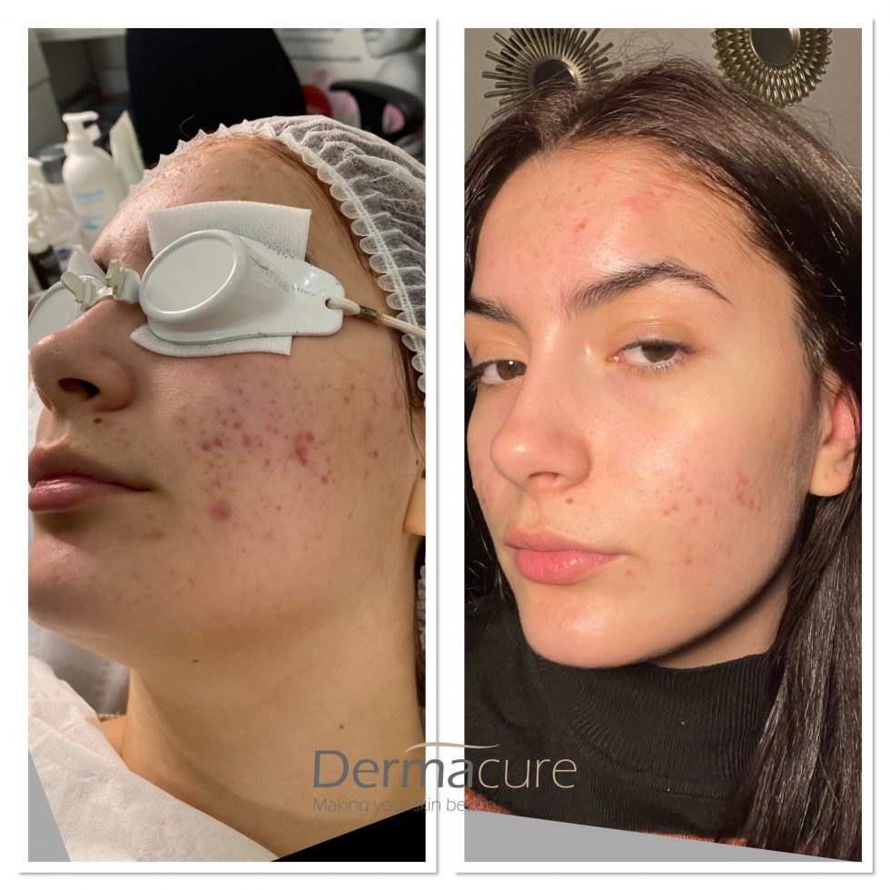 Acne Bespoke Treatment 3 Steps Dermacure Clinic