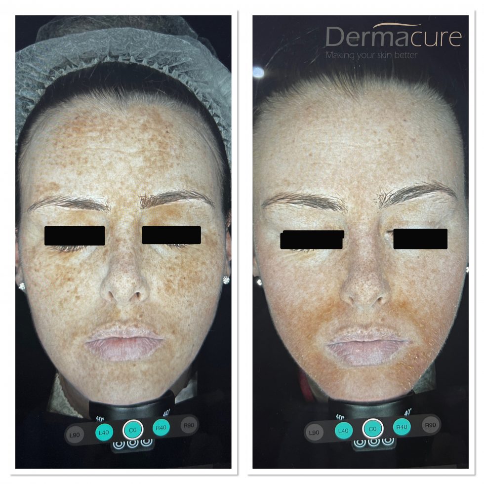 Cosmelan Peel London | Number 1 Depigmentation Treatment | Dermacure Clinic
