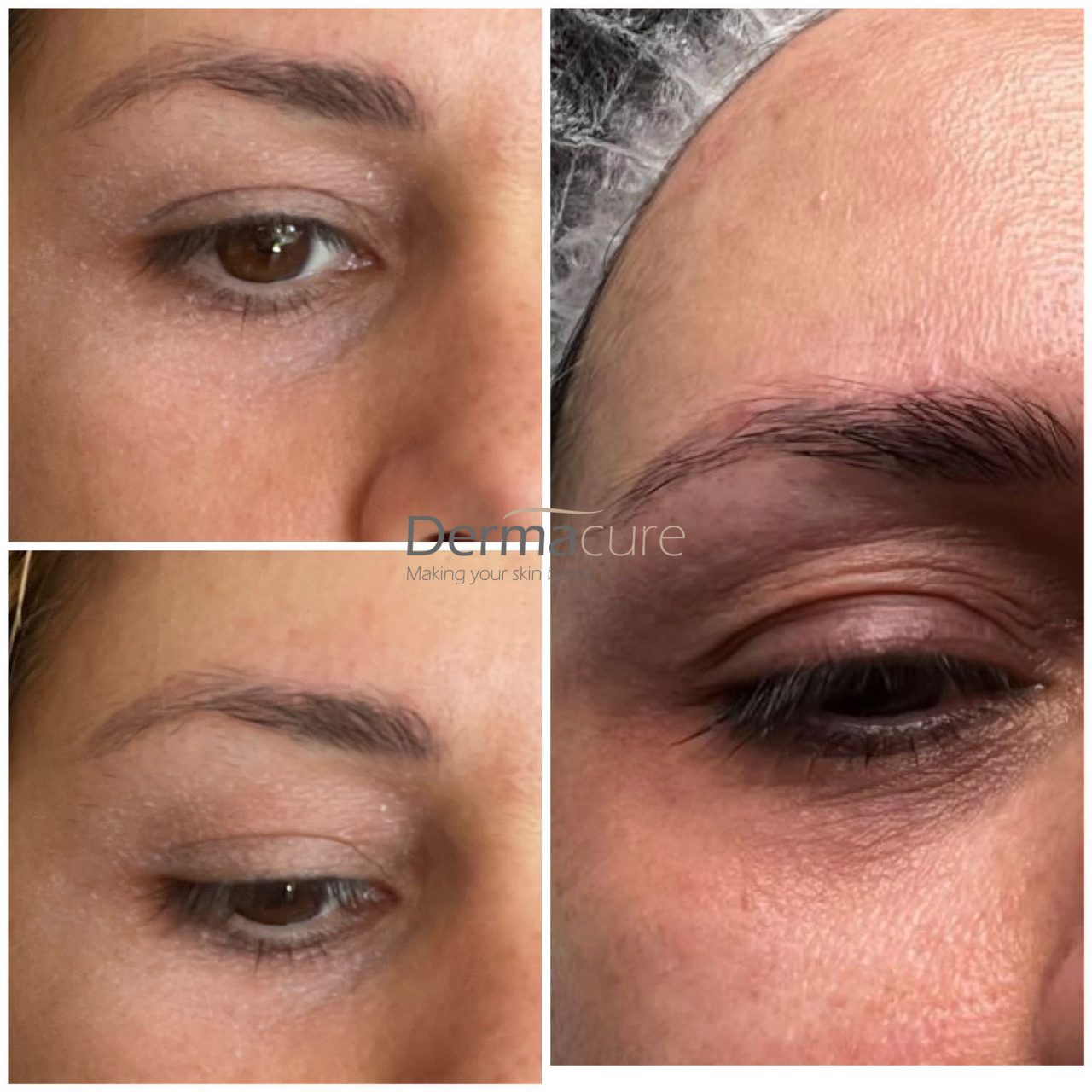 Plasma Pen | Dermacure Clinic