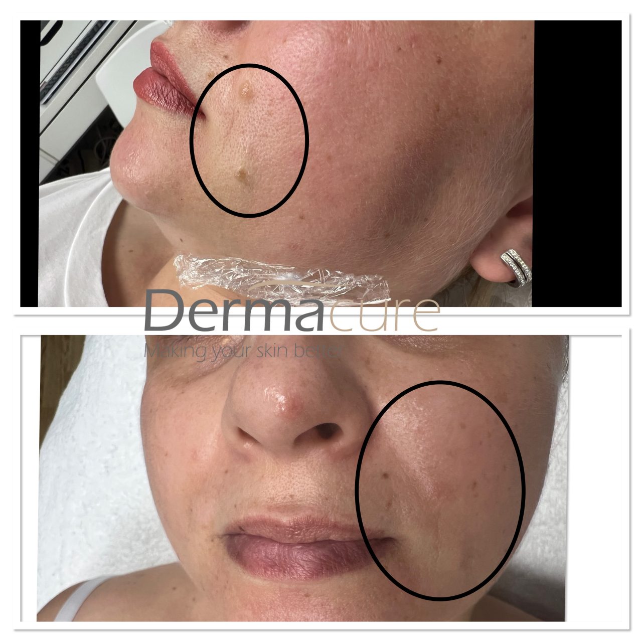 Plasma Pen | Dermacure Clinic