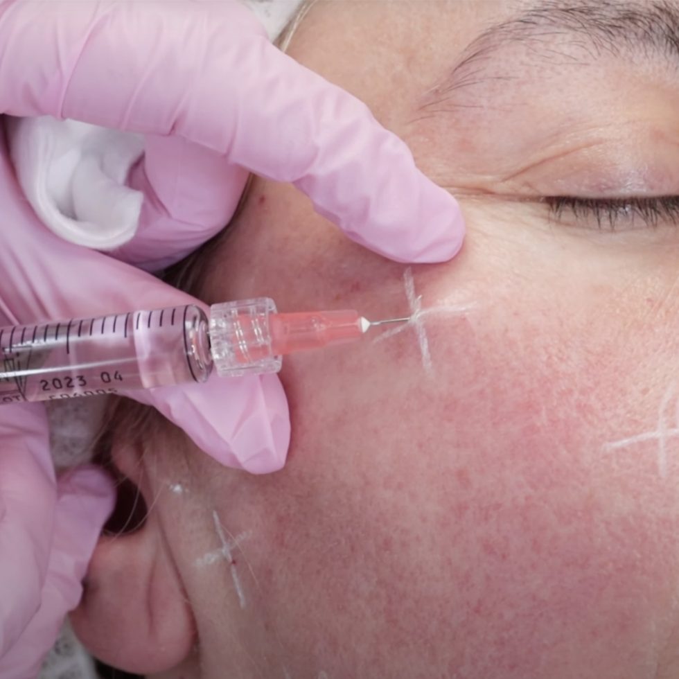 Profhilo | Dermacure Clinic